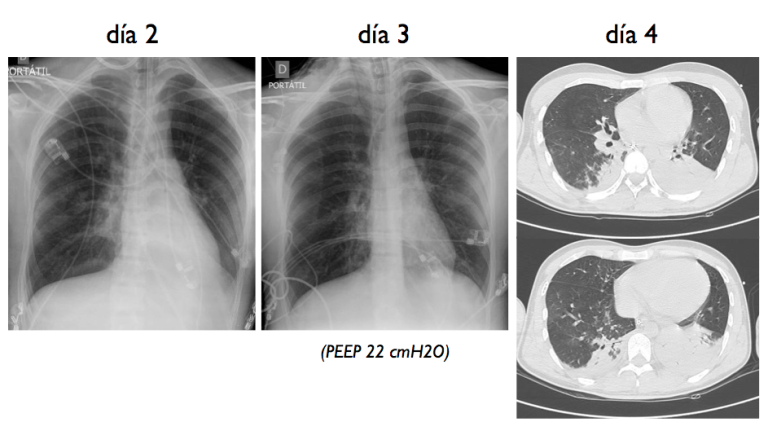 Atelectasias hiperperfundidas - Escuela de Medicina - Facultad de Medicina